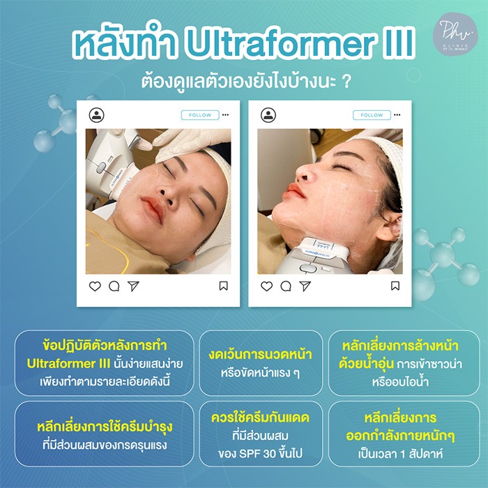 วิธีการดูแลผิวหน้าหลังการทำ Ultraformer III