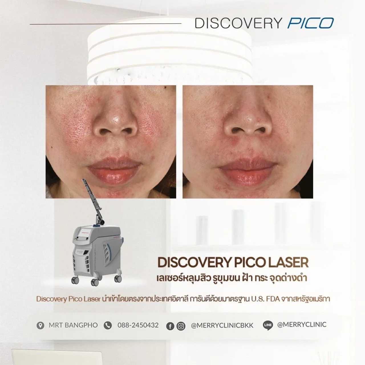 Pico Discovery laser กี่ครั้งเห็นผล เลเซอร์ Pico กี่ครั้งได้ผล