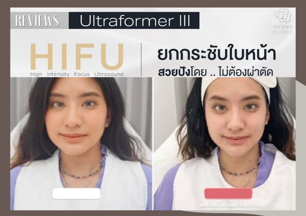 Hifu ULTRAFORMER III รีวิว (Hifu ULTRAFORMER III Review)