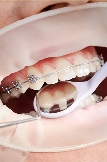 dentist-attaching-metal-braces-patient-teeth2