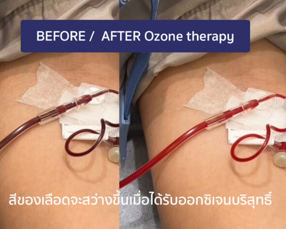 Ozone Therapy