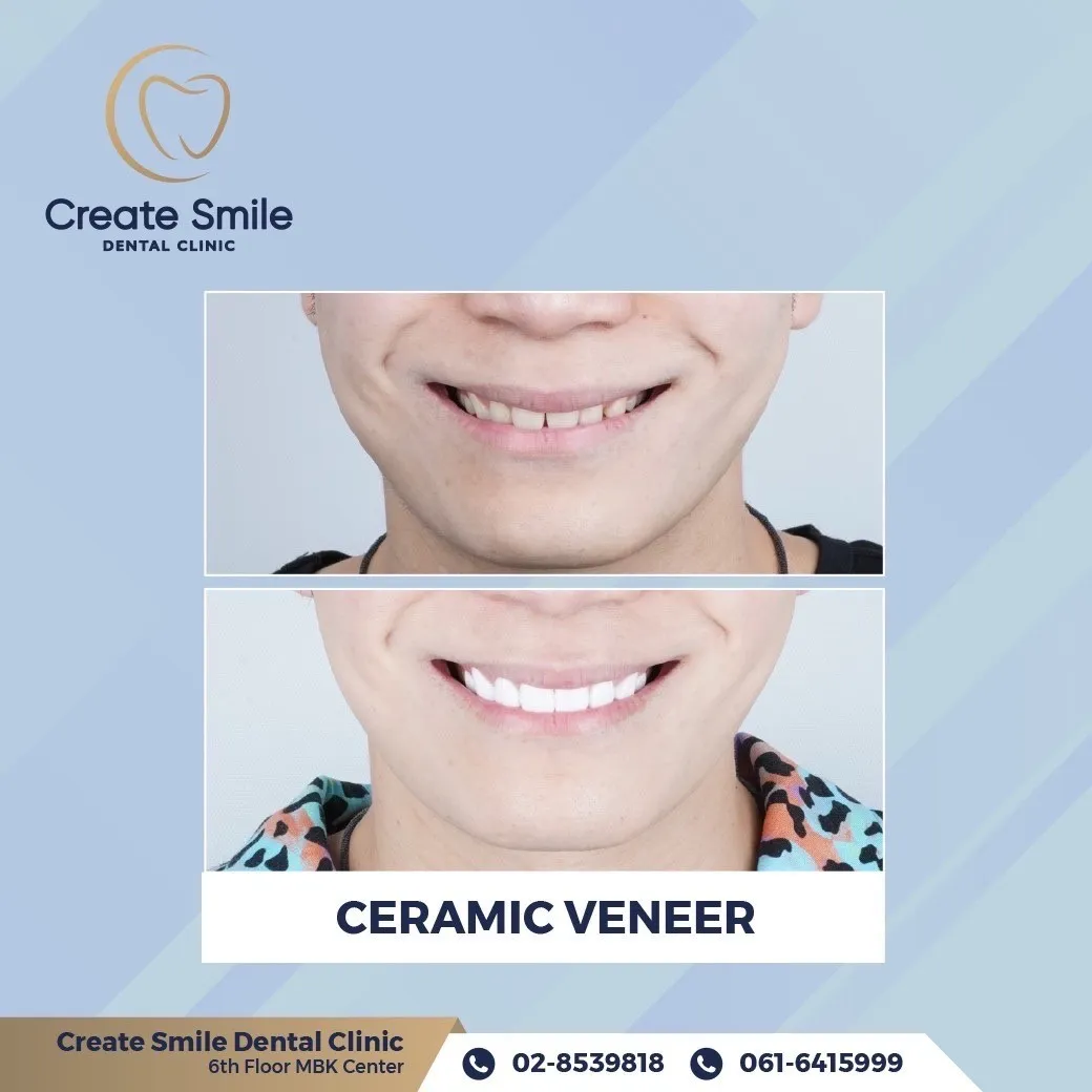 CERAMIC VENEER
