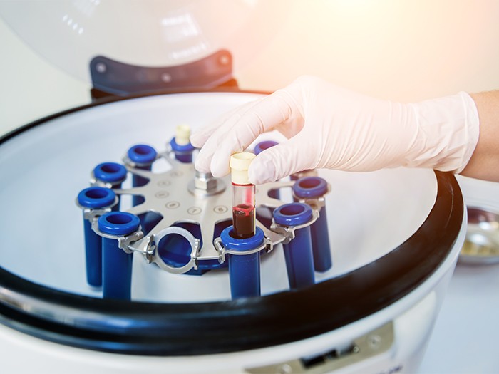 PRP, PRF, Sonicated PRP How they different?