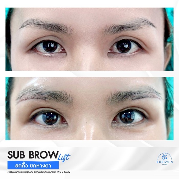 รีวิว Sub brow lift